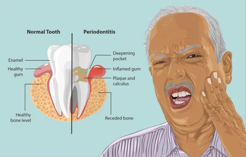 Can Bone Loss in the Jaw Be Reversed? Hygienist Explains. – Tooth Be Told Can Bone Loss in the Jaw Be Reversed? Hygienist Explains. – Tooth Be Told